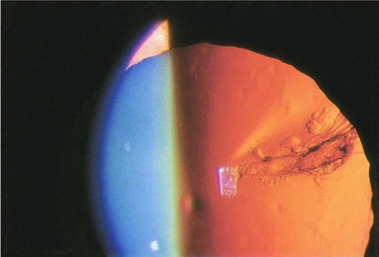Types Of Cataracts The Cataract Course