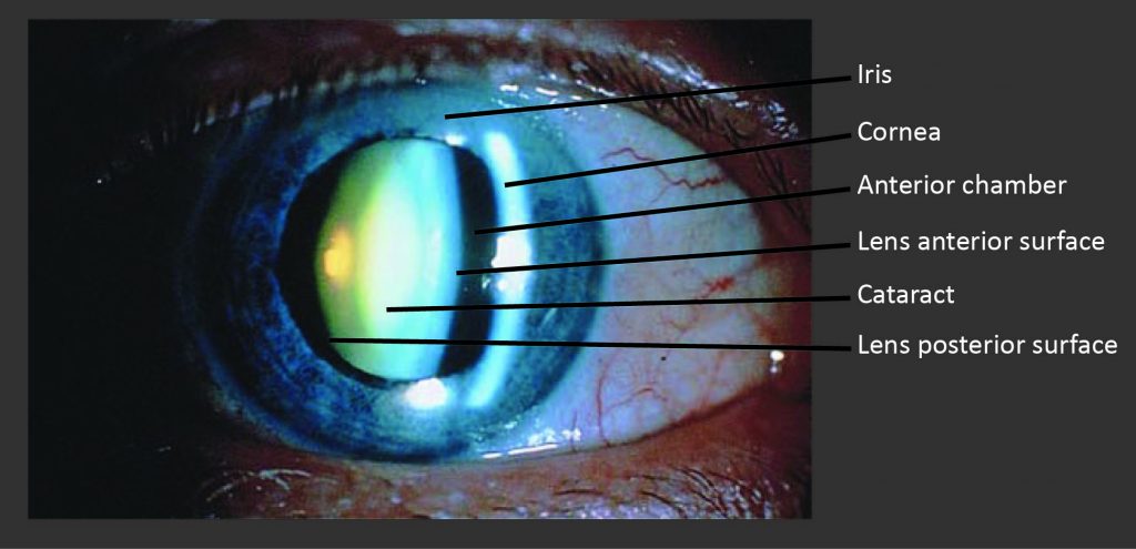 Cataract diagnosis - The Cataract Course