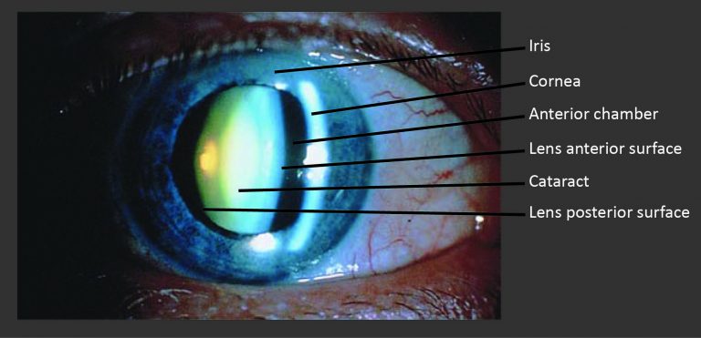 Cataract diagnosis - The Cataract Course